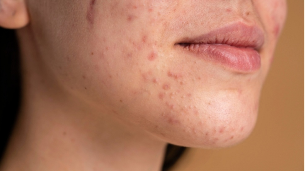 Deretan Kandungan Skincare yang Aman dan Efektif Atasi Bruntusan Kulit ...